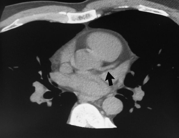 How Healthy Is Your Heart? - RAYUS Radiology
